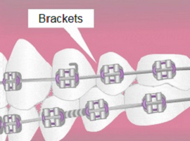 Parts of Braces | Keaton Orthodontics | Pikeville Kentucky