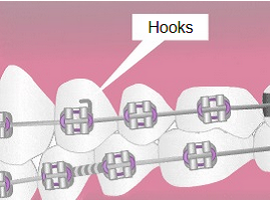 Parts of Braces | Keaton Orthodontics | Pikeville Kentucky